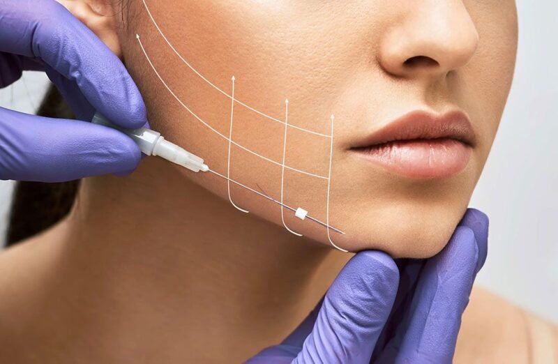 Follow This 7-Day UK Recovery Guide for PDO Thread Lift Aftercare ...